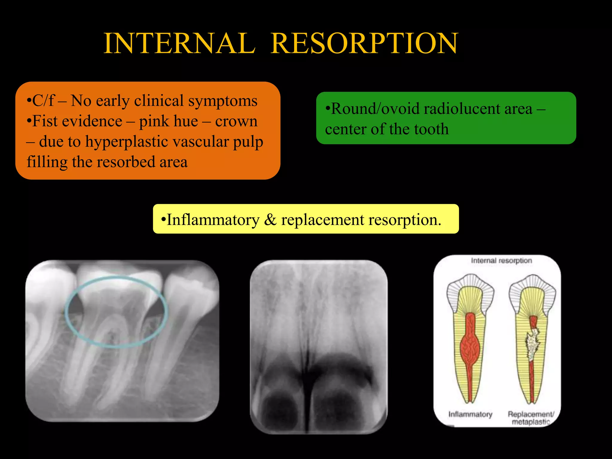 Resorption of teeth | PPTX