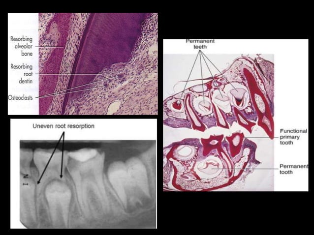 Resorption of teeth | PPTX