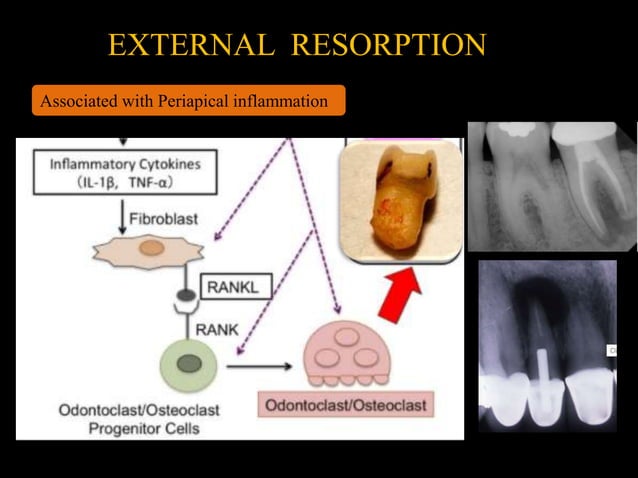 Resorption of teeth | PPTX