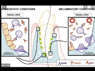 Resorption of teeth | PPTX