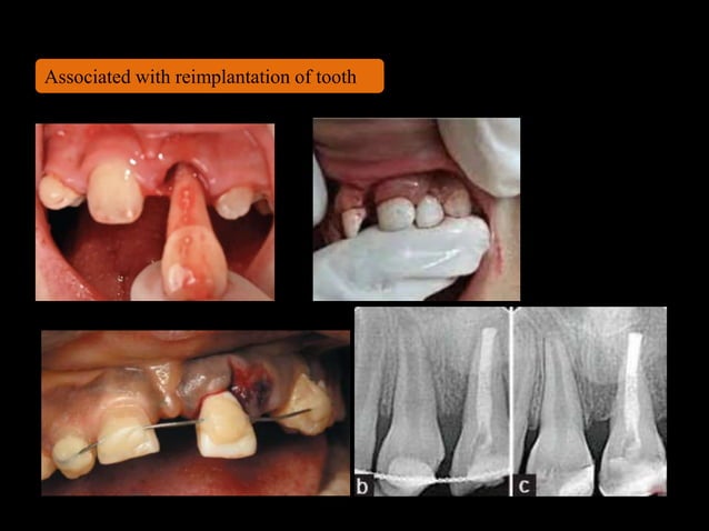 Resorption of teeth | PPTX
