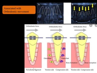 Resorption of teeth | PPTX