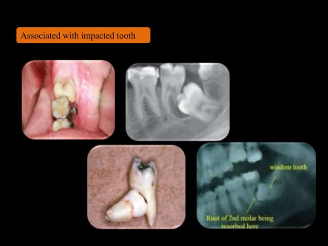 Resorption of teeth | PPTX
