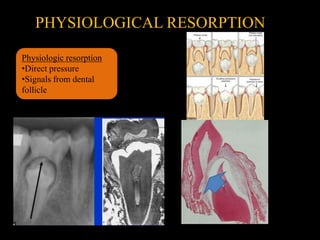 Resorption of teeth | PPTX