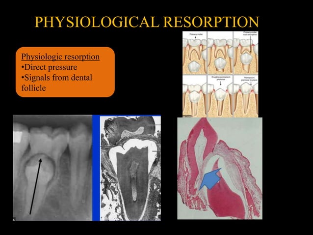 Resorption of teeth | PPTX