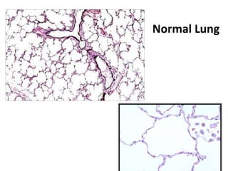 Normal Lung Slide