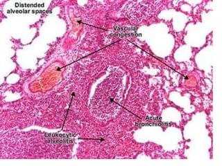Pneumonia Lung Slide