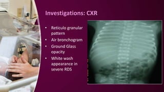 Resp Distress Syndrome | PPTX