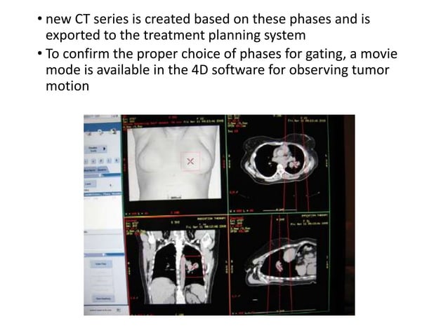 Respiration motion management | PPT | Lung and Respiratory Health ...