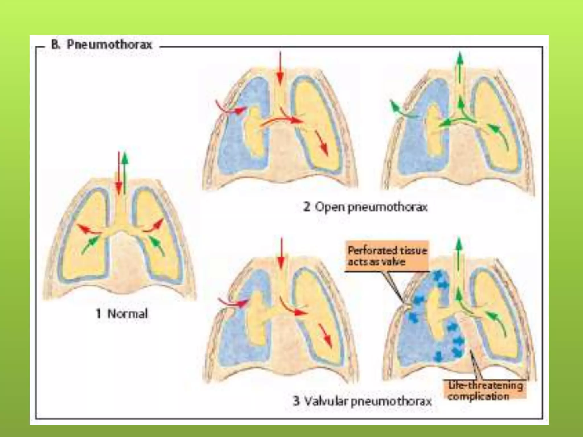 Respiration (Tetyana ma'am) Physiology.ppt | Lung and Respiratory ...