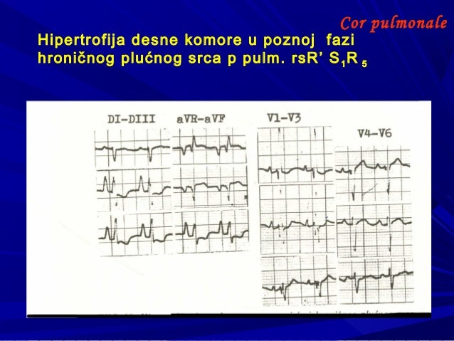 Respiratorna insuficijencija