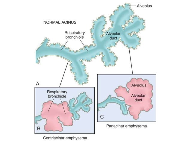 Respiratory.ppt Pathology of the respiratory system | PPT
