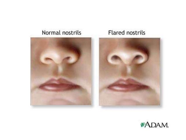 Baby Breathing Retractions