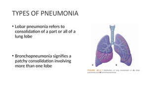 Respiratory disorders of in pathophysiology.pptx