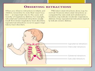 Respiratory disorders peds | PPT