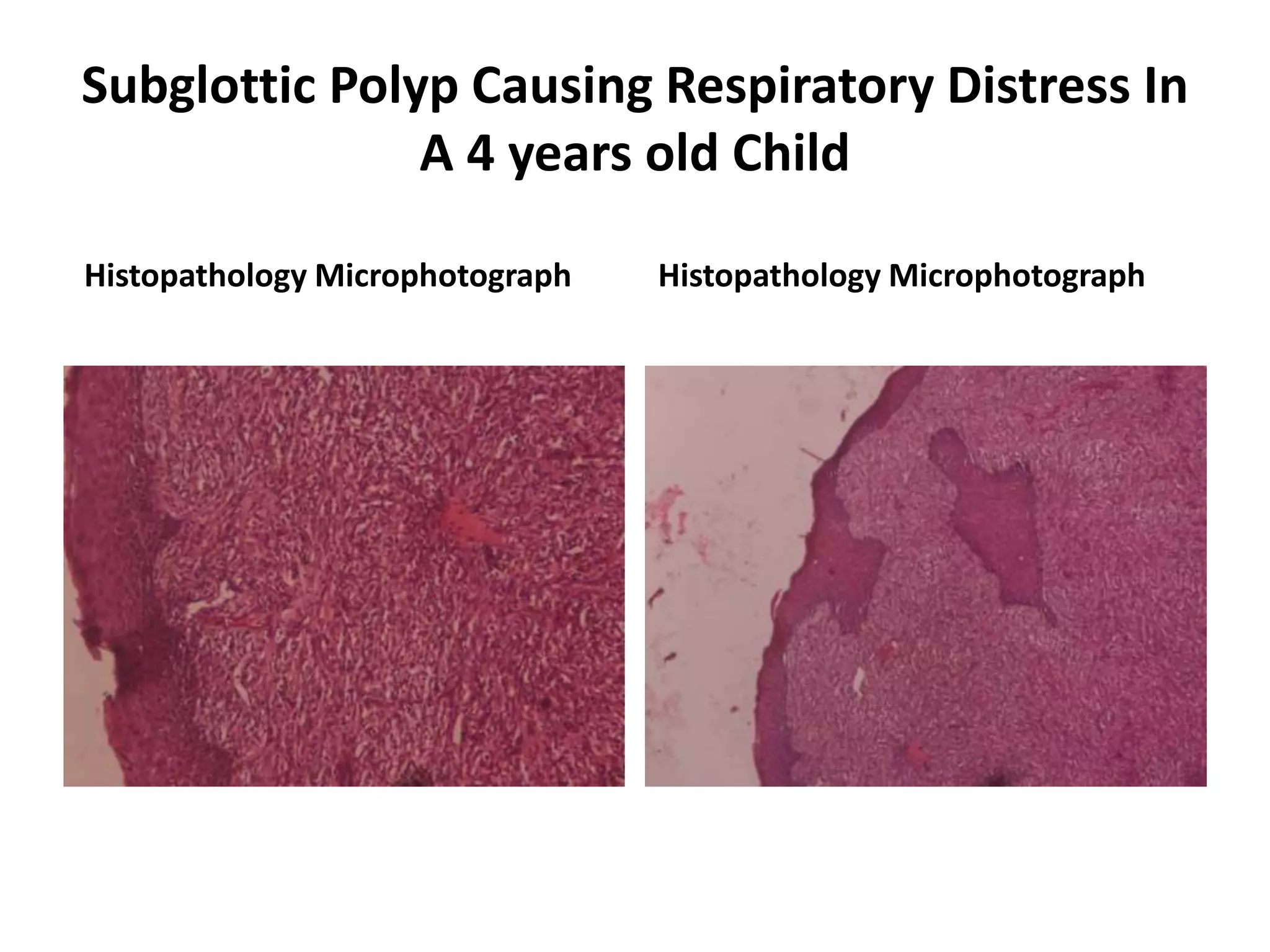 Subglottic Polyp Causing Respiratory distress in a 4 years child | PPT