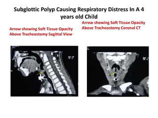 Subglottic Polyp Causing Respiratory distress in a 4 years child | PPT