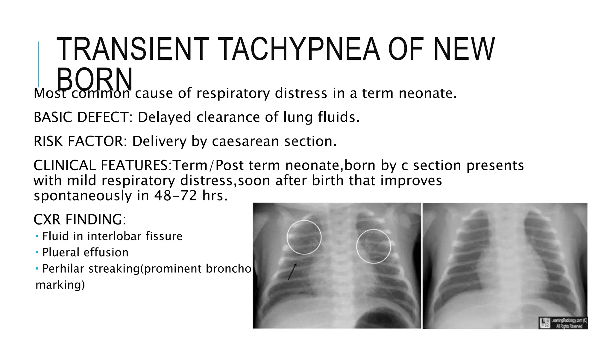 Respiratory distress in neonates.pptx