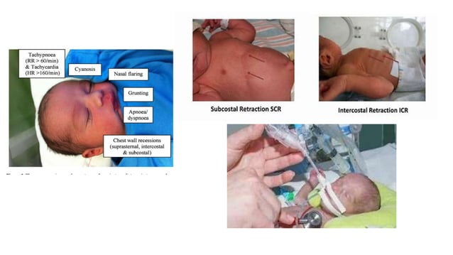 Respiratory distress in neonates.pptx | Lung and Respiratory Health ...
