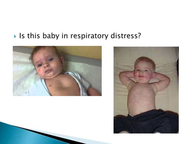 Respiratory distress in neonates | PPTX