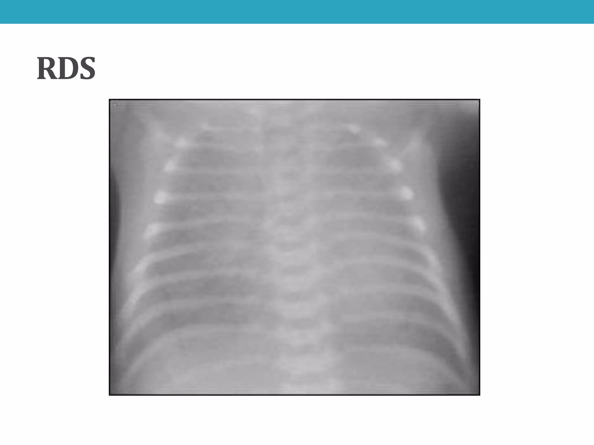Respiratory distress in newborn | PPTX
