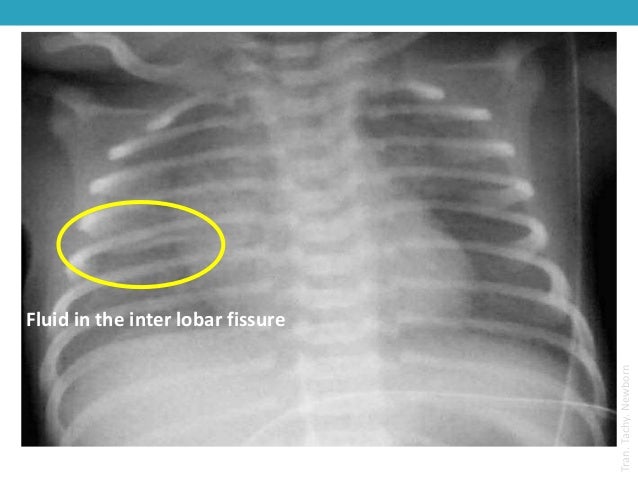 Respiratory distress in newborn