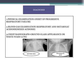 Respiratory distress in newborn | PPTX