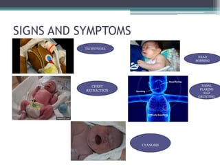 Respiratory distress in newborn | PPTX