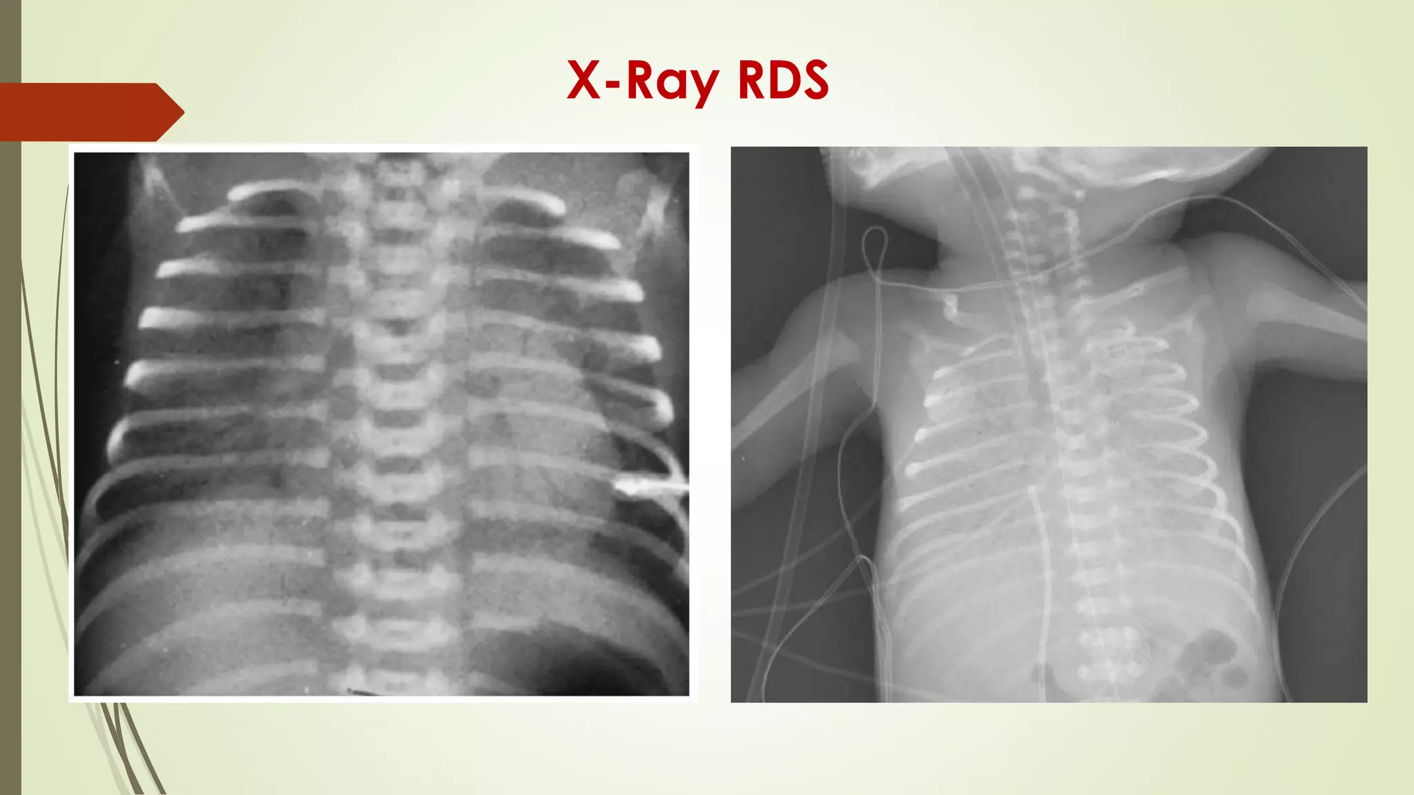 Respiratory distress in newborn | PPTX