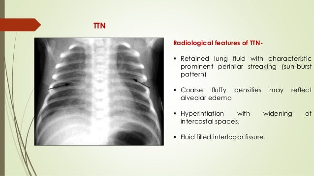 Respiratory distress in newborn