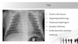 RESPIRATORY DISTRESS IN NEWBORN final.pptx