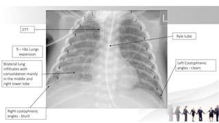 RESPIRATORY DISTRESS IN NEWBORN final.pptx