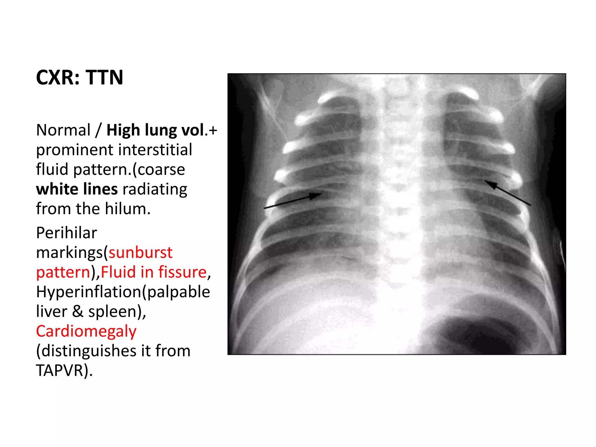 Respiratory distress in the newborn | PPTX