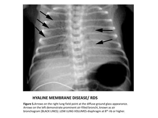 Hyaline Membrane Disease Ground Glass