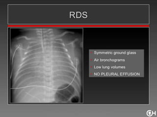 Respiratory Distress Syndrome X Ray