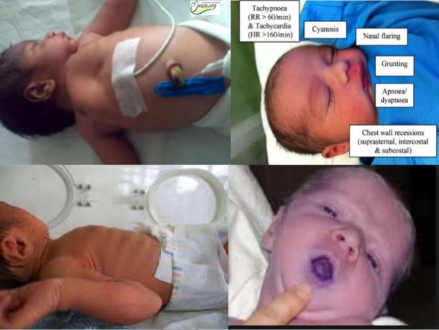 Respiratory distress syndrome