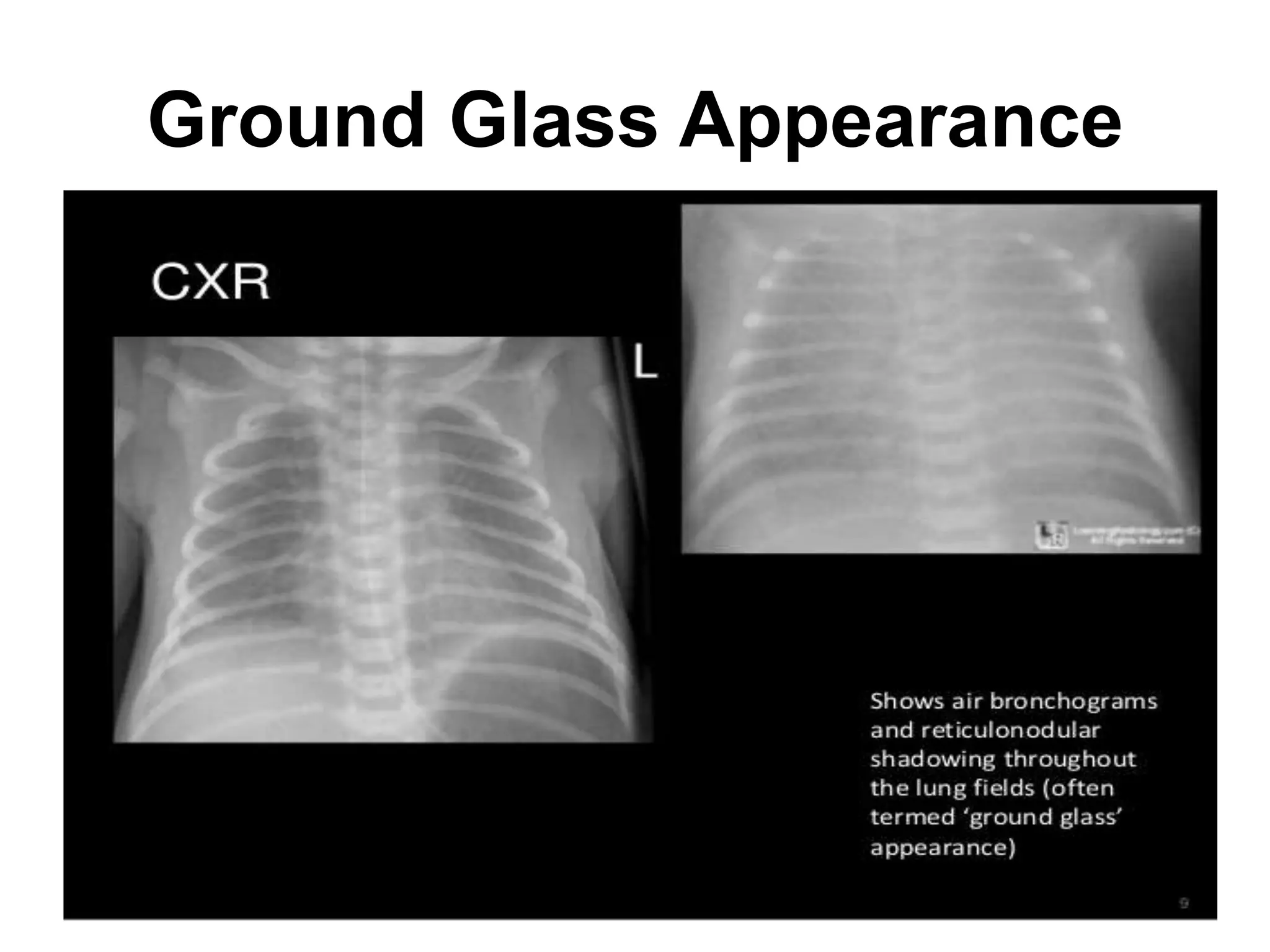 Respiratory distress syndrome