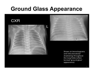 Respiratory distress syndrome | PPTX