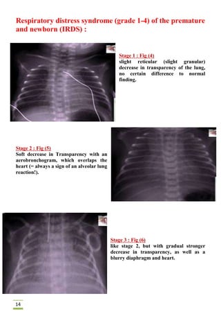 Respiratory distress syndrome 2018 | PDF