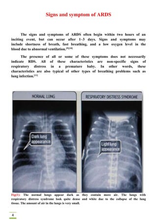 Respiratory distress syndrome 2018 | PDF