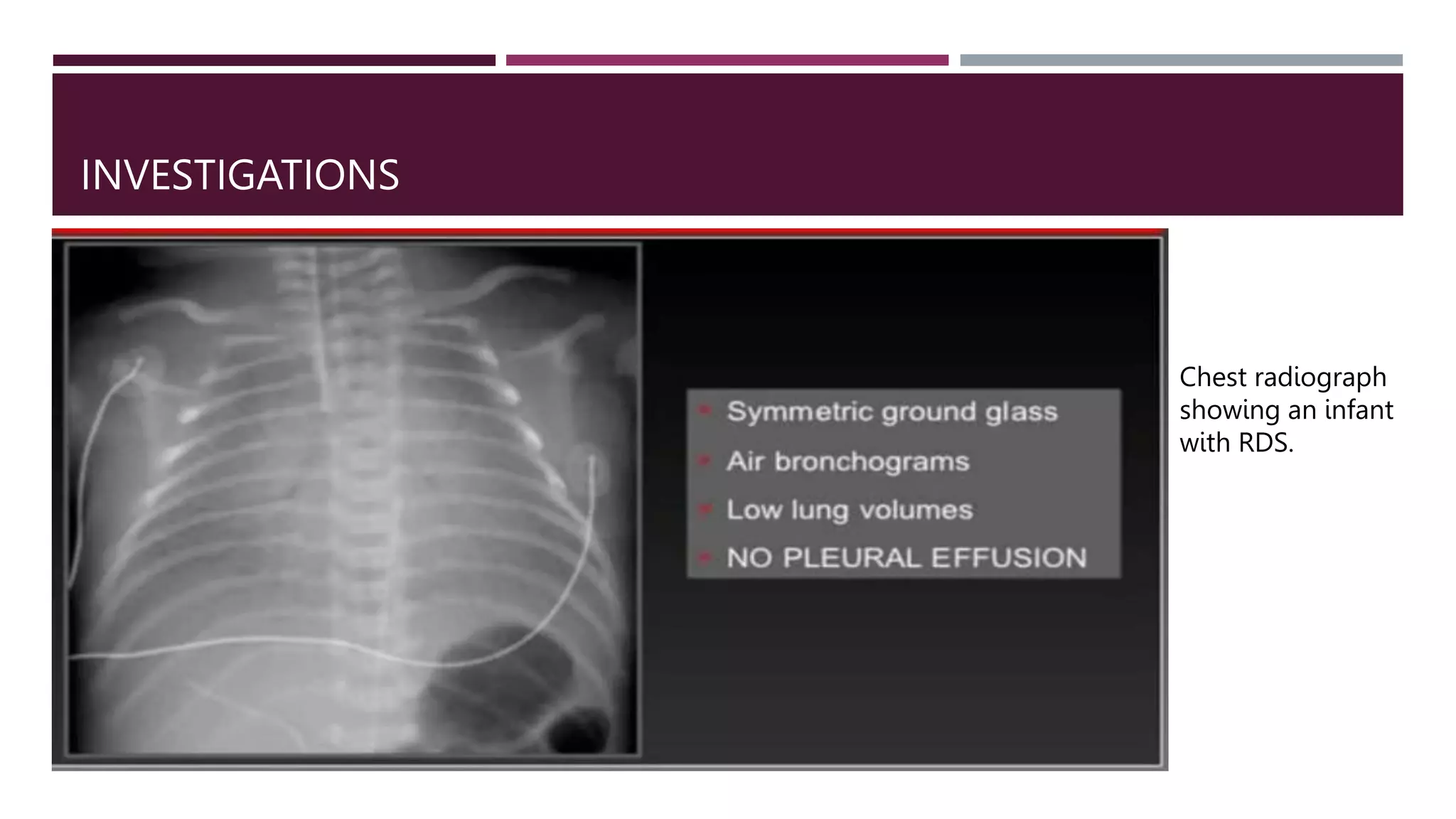 Respiratory Distress Syndrome by DR FAITHFUL DANIEL.pptx