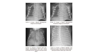 Respiratory Distress Syndrome (RDS).pptx