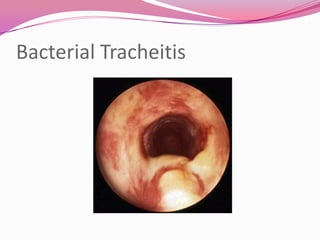 Respiratory Emergencies in Pediatrics | PPT