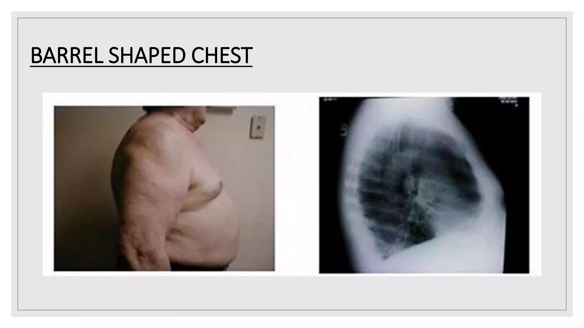 Respiratory examination insp+palp | PPTX