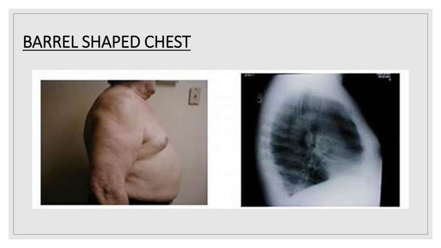 Respiratory examination insp+palp | PPTX