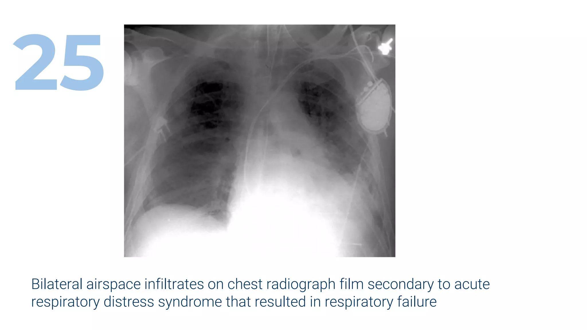 Respiratory failure | PDF