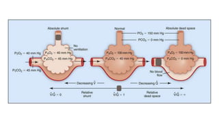 Respiratory Failure - Assesment, Type, and Management | PPTX