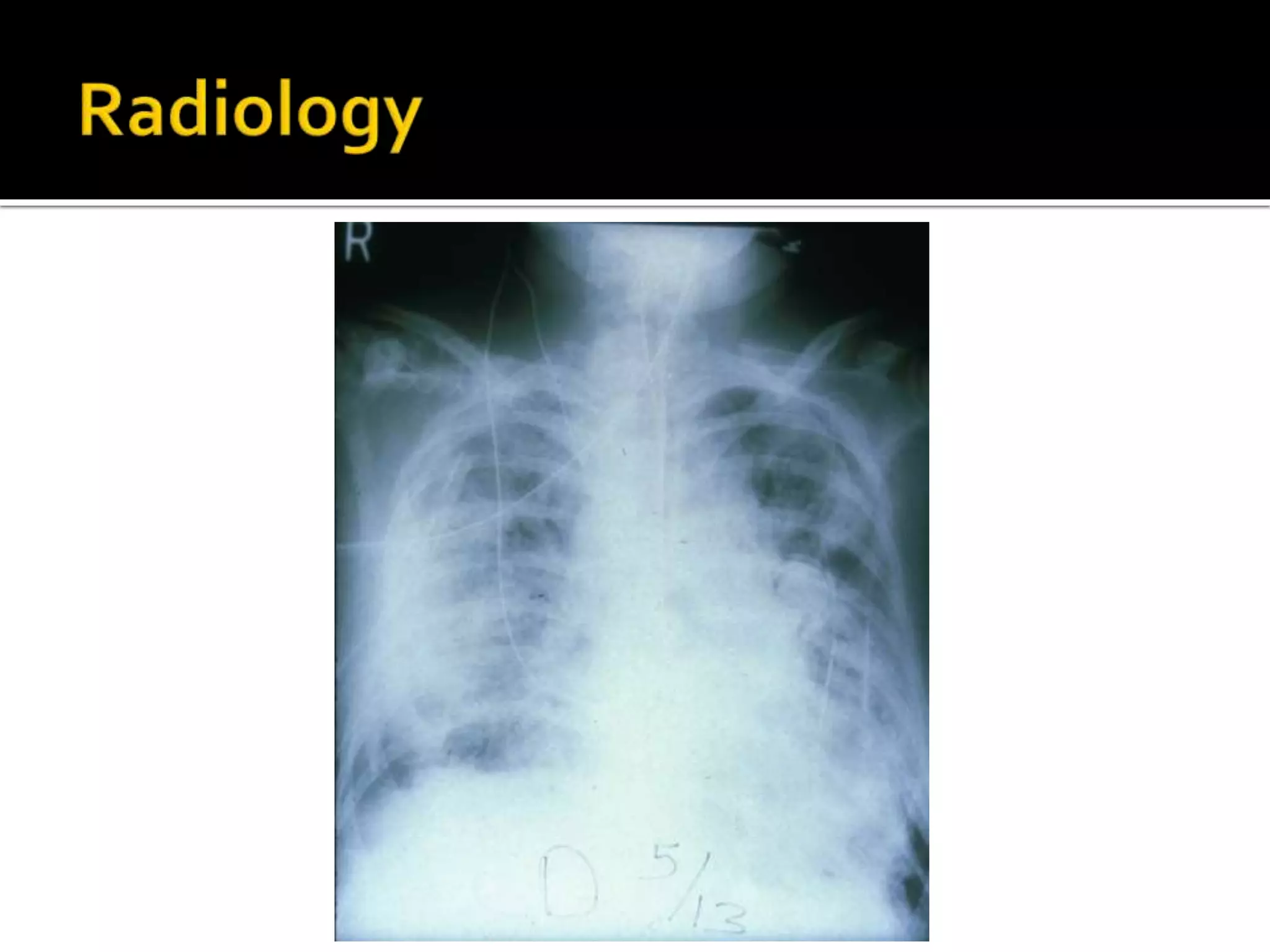Respiratory failure and the acute respiratory distress syndrome (and ...