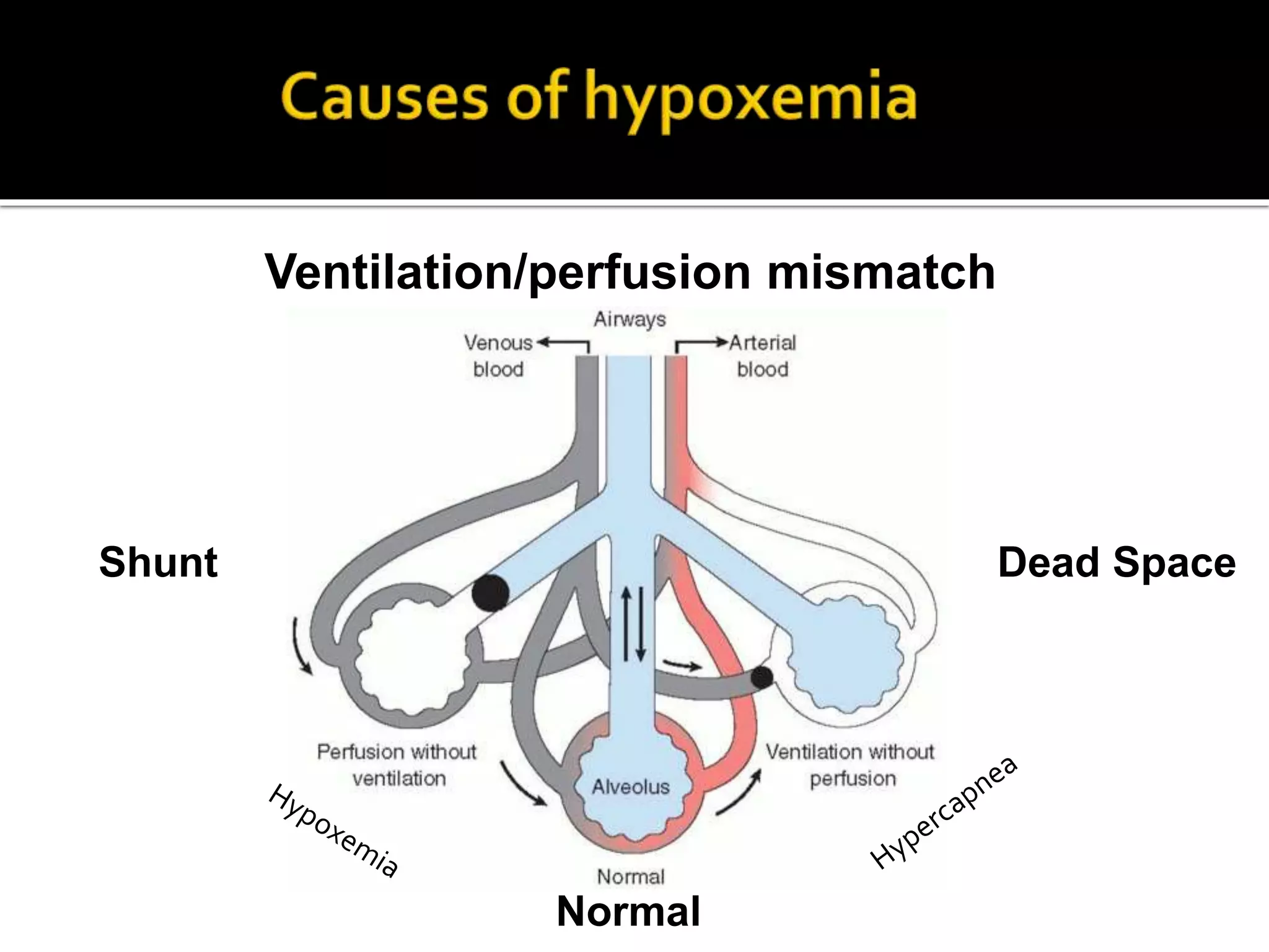 Respiratory failure and the acute respiratory distress syndrome (and ...