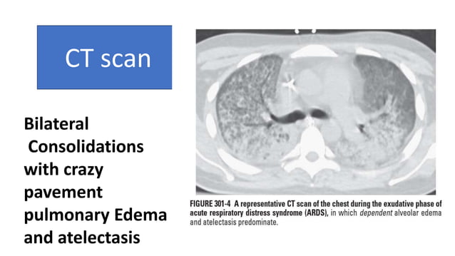 Respiratory Failure ARDS.pptx